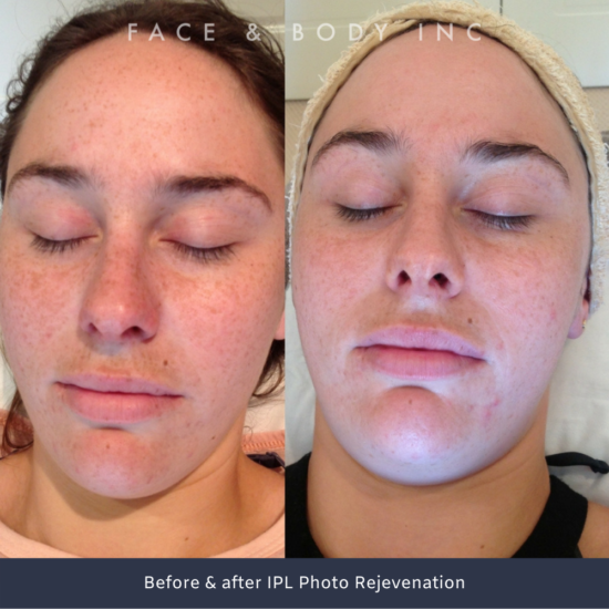 IPL Photo Rejuvenation - Face and Body Inc