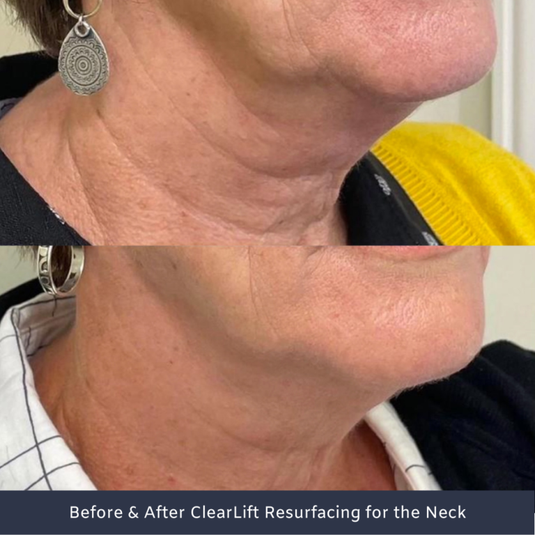 ClearLift Laser - Face and Body Inc