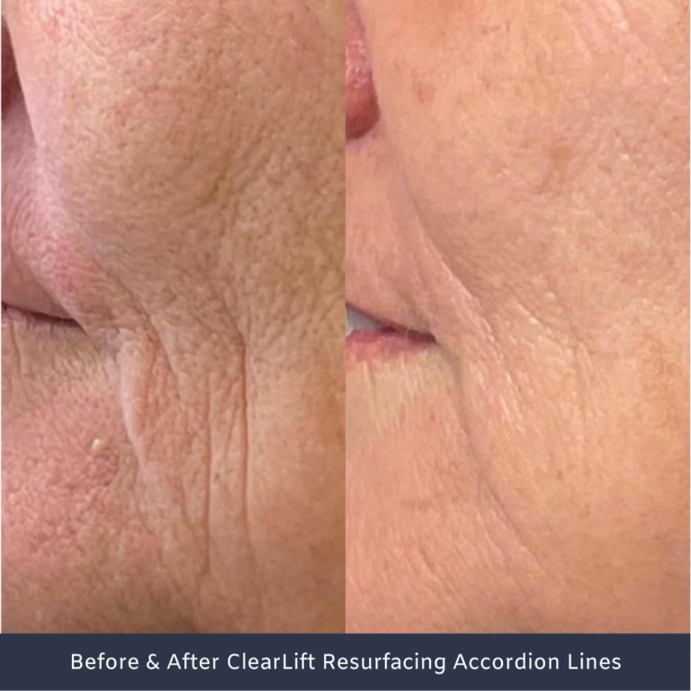 ClearLift Laser - Face and Body Inc
