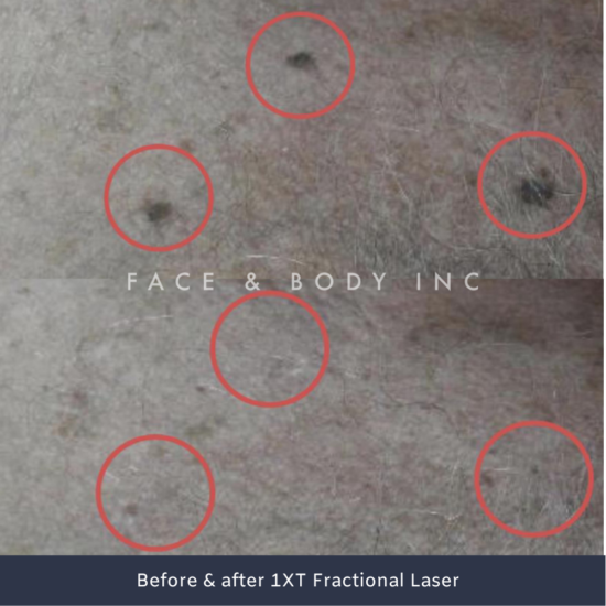 iPixel Laser - Skin Resurfacing Perth - Face and Body Inc