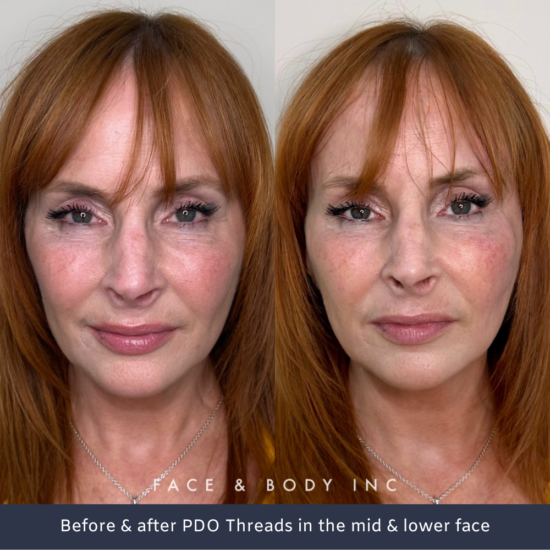 PDO Threads - PDO Thread Lift Perth - Face and Body Inc