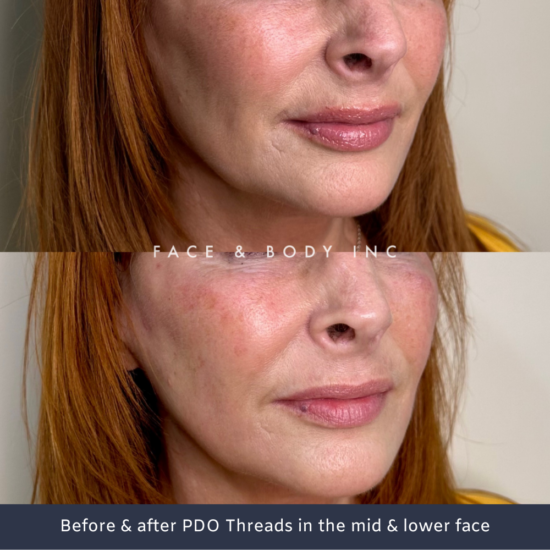 PDO Threads - PDO Thread Lift Perth - Face and Body Inc
