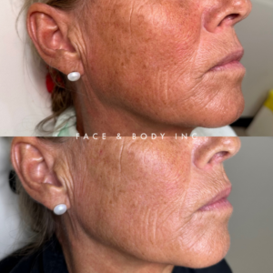 iPixel Laser Resurfacing - Skin Resurfacing Perth - Face and Body Inc