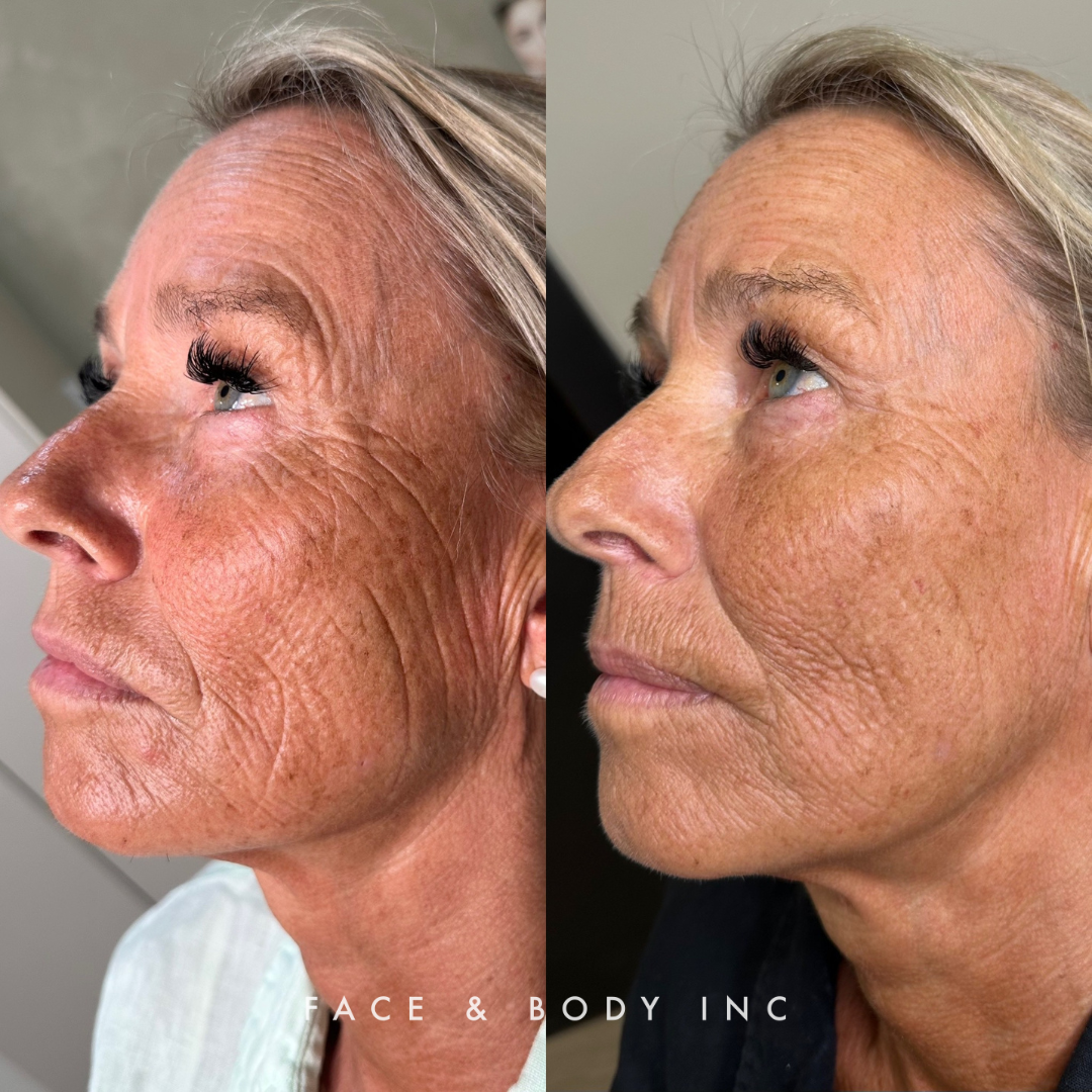 iPixel Laser Resurfacing - Skin Resurfacing Perth - Face and Body Inc