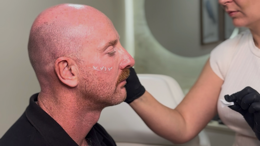 Platelet Rich Plasma - PRP Vampire Facial Perth - Face and Body Inc